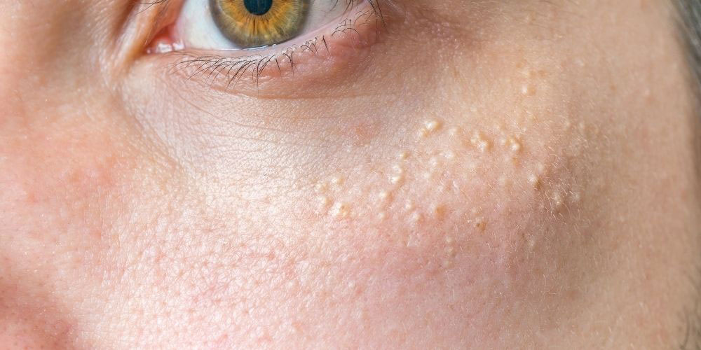 Cysts | Cibolo Creek Dermatology Group