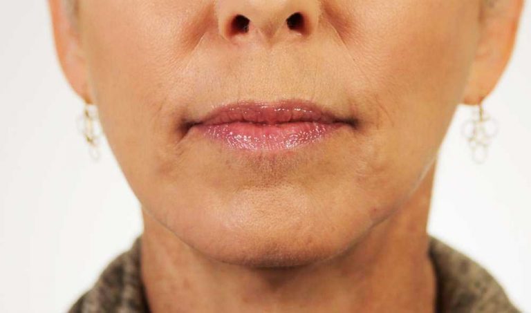 VERSA™ Lip Filler | Cibolo Creek Dermatology Group