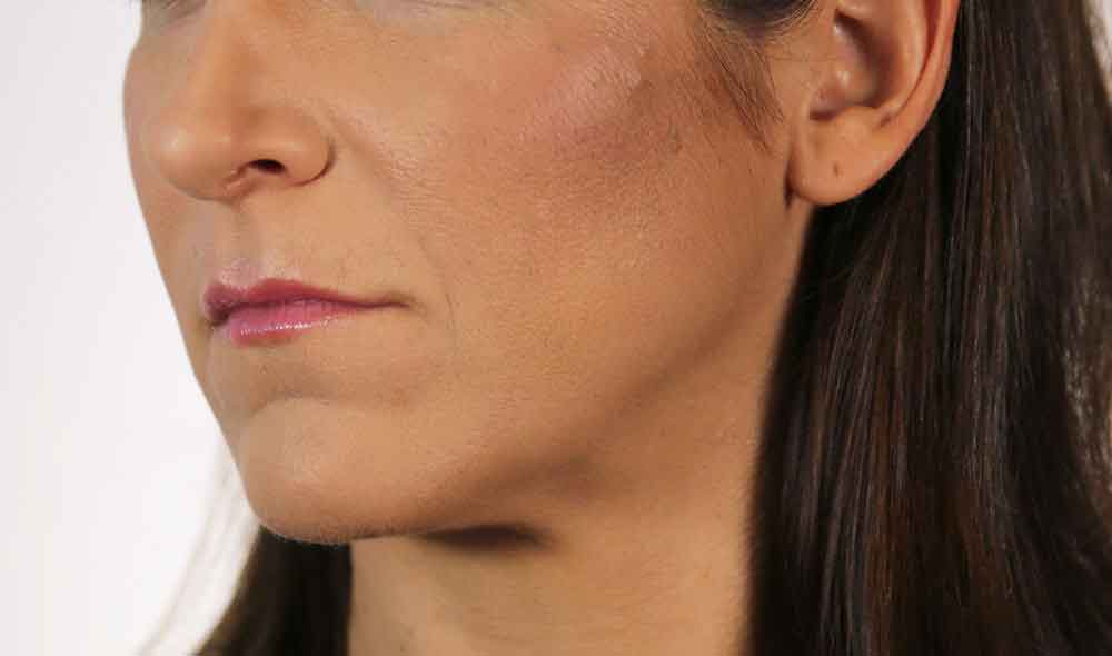 VERSA™ Lip Filler | Cibolo Creek Dermatology Group