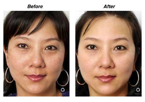 The Perfect Derma™ Chemical Peel | Cibolo Creek Dermatology Group
