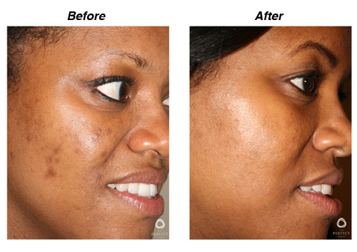 The Perfect Derma™ Chemical Peel | Cibolo Creek Dermatology Group