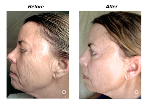 The Perfect Derma™ Chemical Peel | Cibolo Creek Dermatology Group
