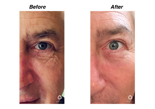 The Perfect Derma™ Chemical Peel | Cibolo Creek Dermatology Group