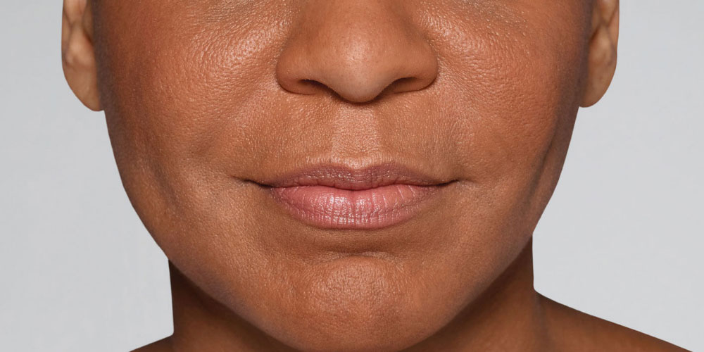 RESTYLANE® Fillers | Cibolo Creek Dermatology Group