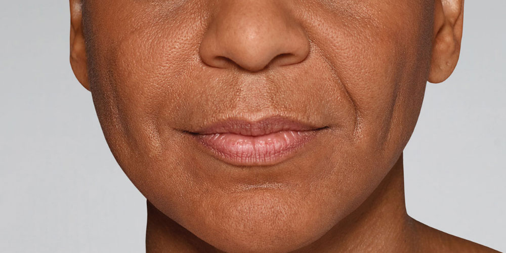 RESTYLANE® Fillers | Cibolo Creek Dermatology Group