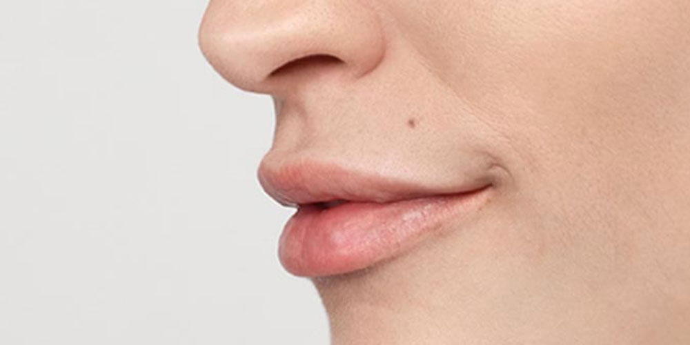 RESTYLANE® Fillers | Cibolo Creek Dermatology Group