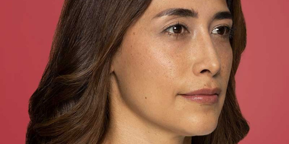 RESTYLANE® Fillers | Cibolo Creek Dermatology Group