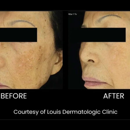 NOUVADerm Laser System | Cibolo Creek Dermatology Group